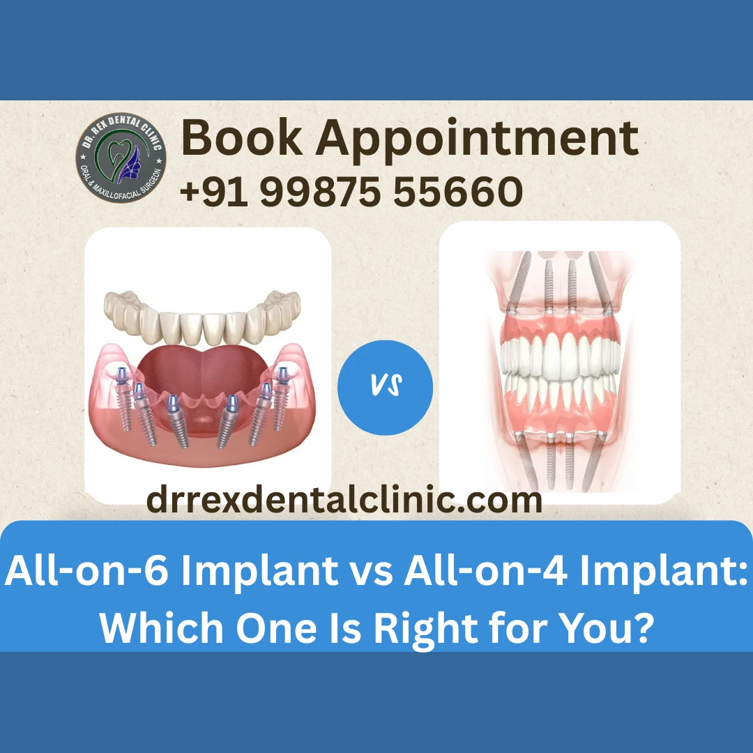 All-on-6 Implant vs All-on-4 Implant: Which One Is Right for You? - Dr. Rex Dental Clinic
